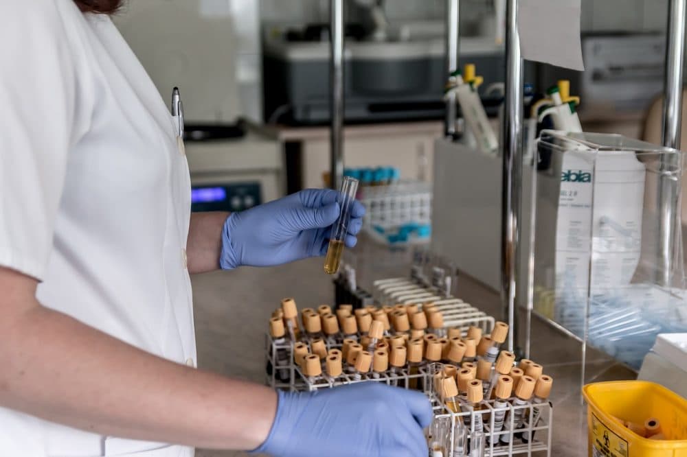 Prostate cancer urine test identifies good prognosis patients