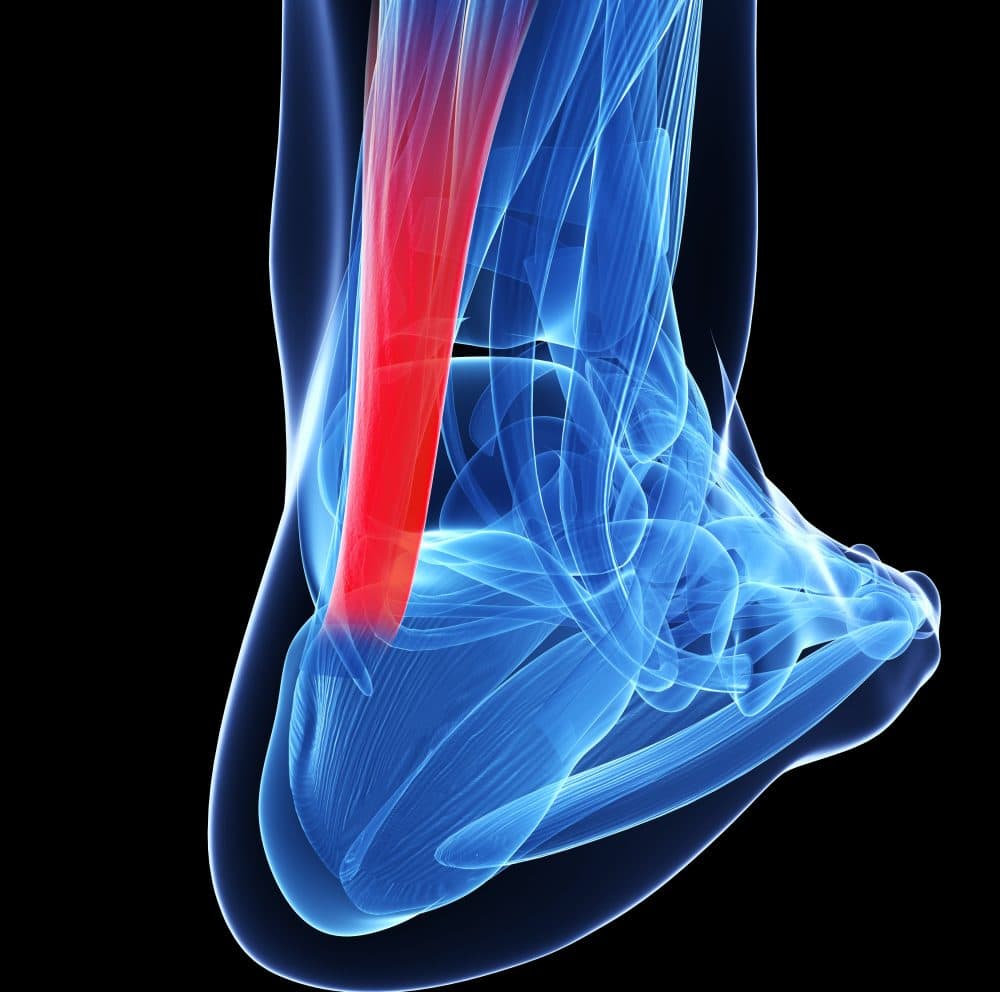 Biomaterial sticks to injured tendons and releases anti-inflammatory drugs